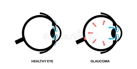 Glaucoma Eye Pressure Stock Vector Illustration Of Canal 325900926