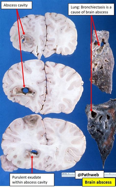Brain Abscess Nus Pathweb Nus Pathweb