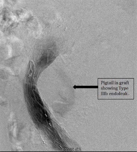 Pre Operative Angiogram Demonstrating Type Iiib Endoleak From Proximal