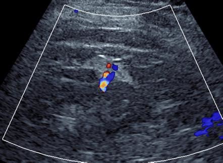 Renal Angiomyolipoma Ultrasound