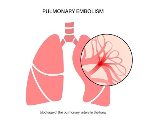 Doença de embolia pulmonar Vetor Premium