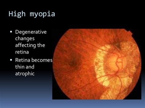 Degenerative Myopia Retina Halobasta