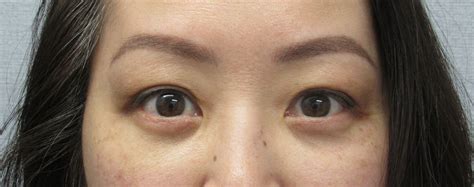 Asian Eyelid Surgery Gallery Northeastern Plastic Surgery