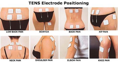 Tens Unit Sciatica Electrode Placement Yahoo Image Search Results