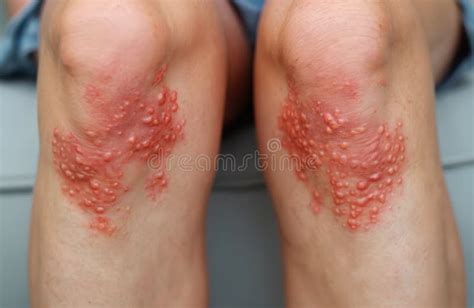 Photodermatitis Stock Illustrations 5 Photodermatitis Stock