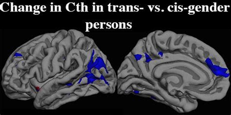 Cross Sex Hormone Treatment Is Linked With A Reversal Of Cerebral