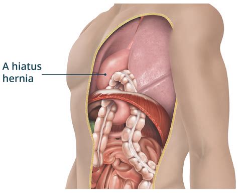 Hiatus Hernia Mesh
