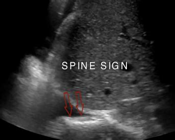 Spine Sign Medicin Wiki