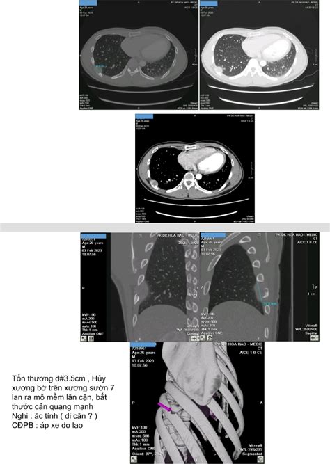 Vietnamese Medic Ultrasound Case 682 Rib Chondrosarcoma Dr Phan