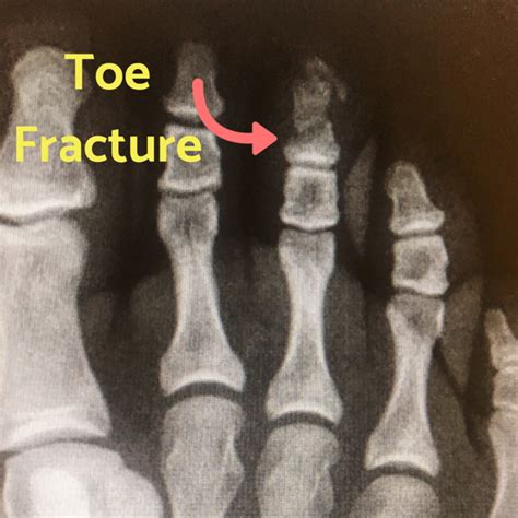 Unicameral Bone Cyst Final Kick Ankle And Foot Clinic Ankle And Foot