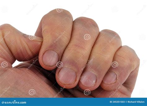Hand With Bitten Nails Close Up Stock Image Image Of Damaged Nails
