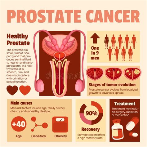 Flat Cartoon Infographic Detailing Prostate Cancer Risk Factors And Stages Stock Vector