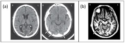 Apperceptive Agnosia