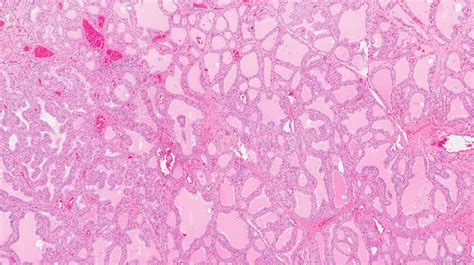 Diffuse Papillary Hyperplasia Ottawa Atlas Of Pathology