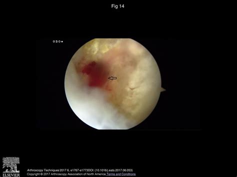 Vertical Lasso And Horizontal Lasso Sutures For Repair Of Horizontal