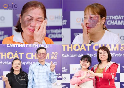 Sạch Chàm Bớt Thay Diện Mạo Hàng Ngàn Cuộc đời được Viết Lại Tại