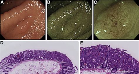 A Diminutive De Novo Cancer Of The Sigmoid Colon With Nondepressed