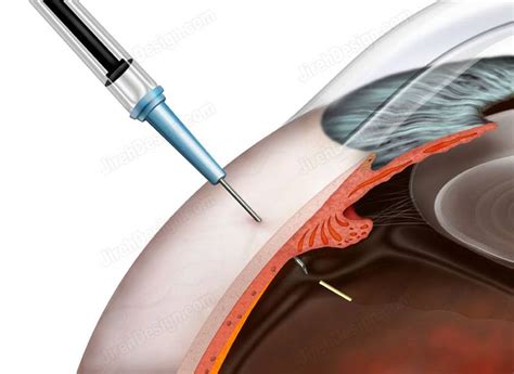 Intravitreal Dexamethasone Implant Suvr0085 Stock Eye Images
