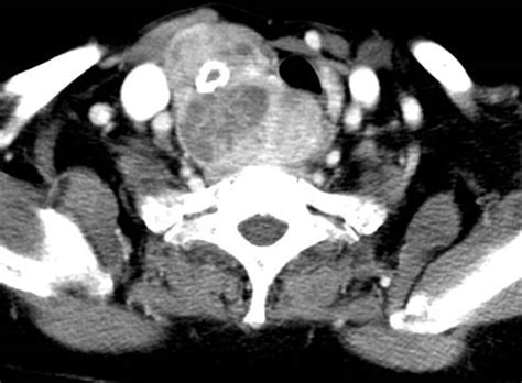 Papillary Thyroid Carcinoma Radiology Cases