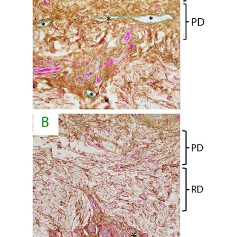 A Human Dermis Histology Demonstrating Hyaluronan Staining Ha Brown
