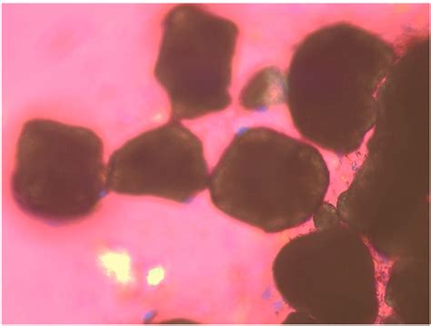Figure 3 From Similarities And Differences Between Biliary Sludge And