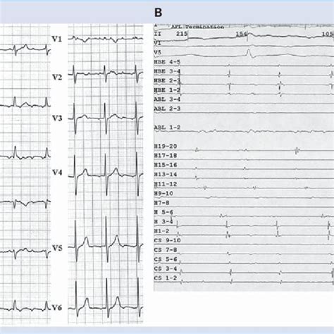 Pdf Typical Atrial Flutter With Atypical Flutter Wave Morphology Due To Abnormal Interatrial