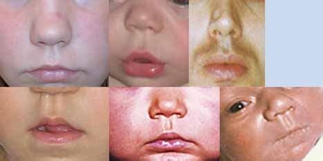 Elements Of Morphology Standard Terminology For The Nose And Philtrum