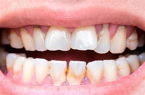 8 Causes Of Exposed Dentin Signs Symptoms And Treatments