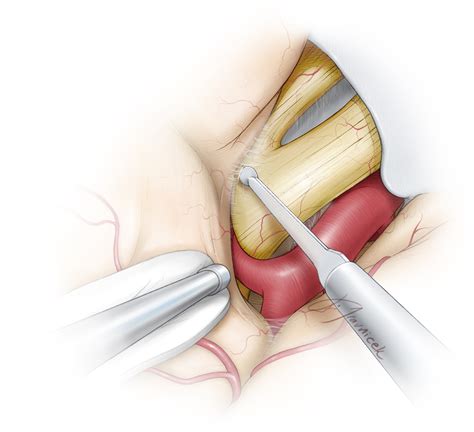 Anterior Communicating Artery Aneurysm The Neurosurgical Atlas