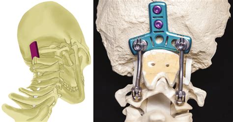 Left 3d Illustration Demonstrating The Interpositional Relationship Of