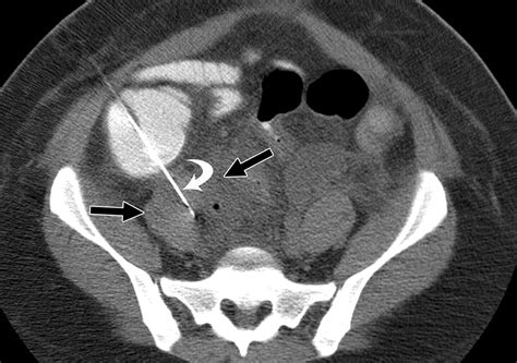 Percutaneous Abscess Drainage In Patients With Perforated Acute