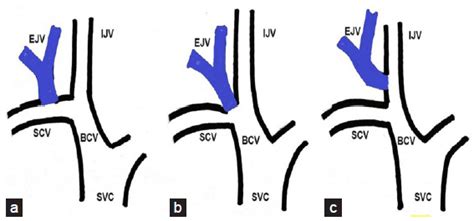 Tunneled Dialysis Catheter Insertion In External Jugular Vein By