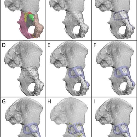 Design Workflow For Creating Customised Fracture Plates A Left