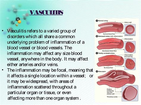 Auto Immune Vasculopathy And Scleroderma Ayurvedic Perspective Ppt