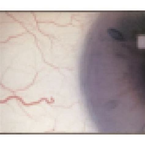 Efron Grading Scale From A To E Lower To Higher Values