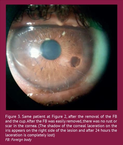 Corneal Rust Ring Complications