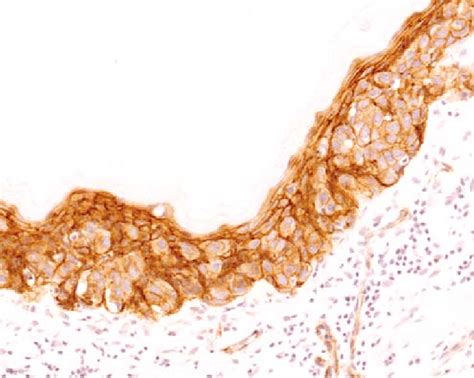 Plakoglobin Protein Expression In Non Invasive Pagets Disease Of The