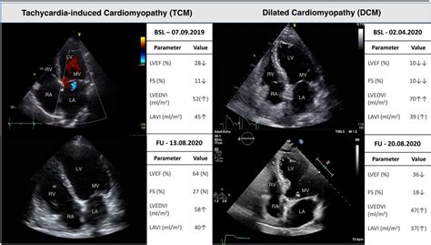 Apical 45 Chamber Tte Views Of A Patient With Tcm Left At Baseline