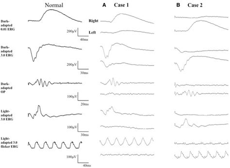 Full Field Electroretinograms Ergs Recorded From Two Cases Of