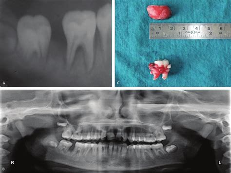 A B Iopa And Opg Showing Root Resorption Of Right Mandibular First