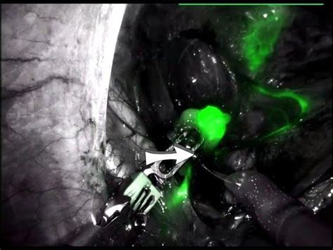 How Robotic Sentinel Node Mapping For Endometrial Cancer Dr Viral Patel Posted On The Topic