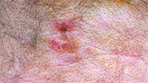 Skin Lesion Symptom In Shingles Or Herpes Zoster In Person Viral