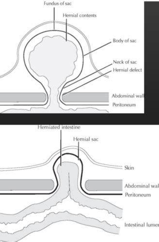 Body Wall Defects Flashcards Quizlet