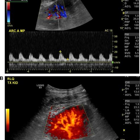 Spectral Doppler Waveforms Ultrasound And Color Power Image Of The