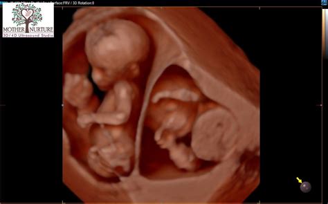Triplets 3d Ultrasound Epos™