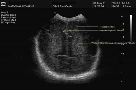 Cranial Ultrasound A Guideline For The Performance Of Routine Cranial