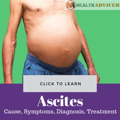 Ascites Photos Beginning Stages Lihs