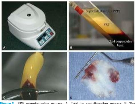Figure 3 From Effect Of Platelet Rich Fibrin Membrane On The Expression
