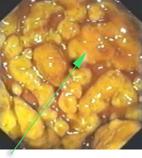 Pseudomembranous Colitis Stool