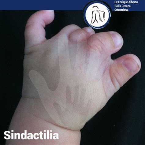 La Sindactilia Es Una Dr Enrique Alberto Solís Peraza Facebook